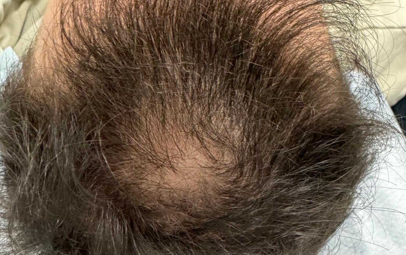 T-Lab™ PRP Kits and Tubes (Platelet-Rich Plasma Tubes)