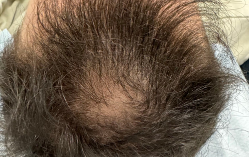 T-Lab™ PRP Kits and Tubes (Platelet-Rich Plasma Tubes)