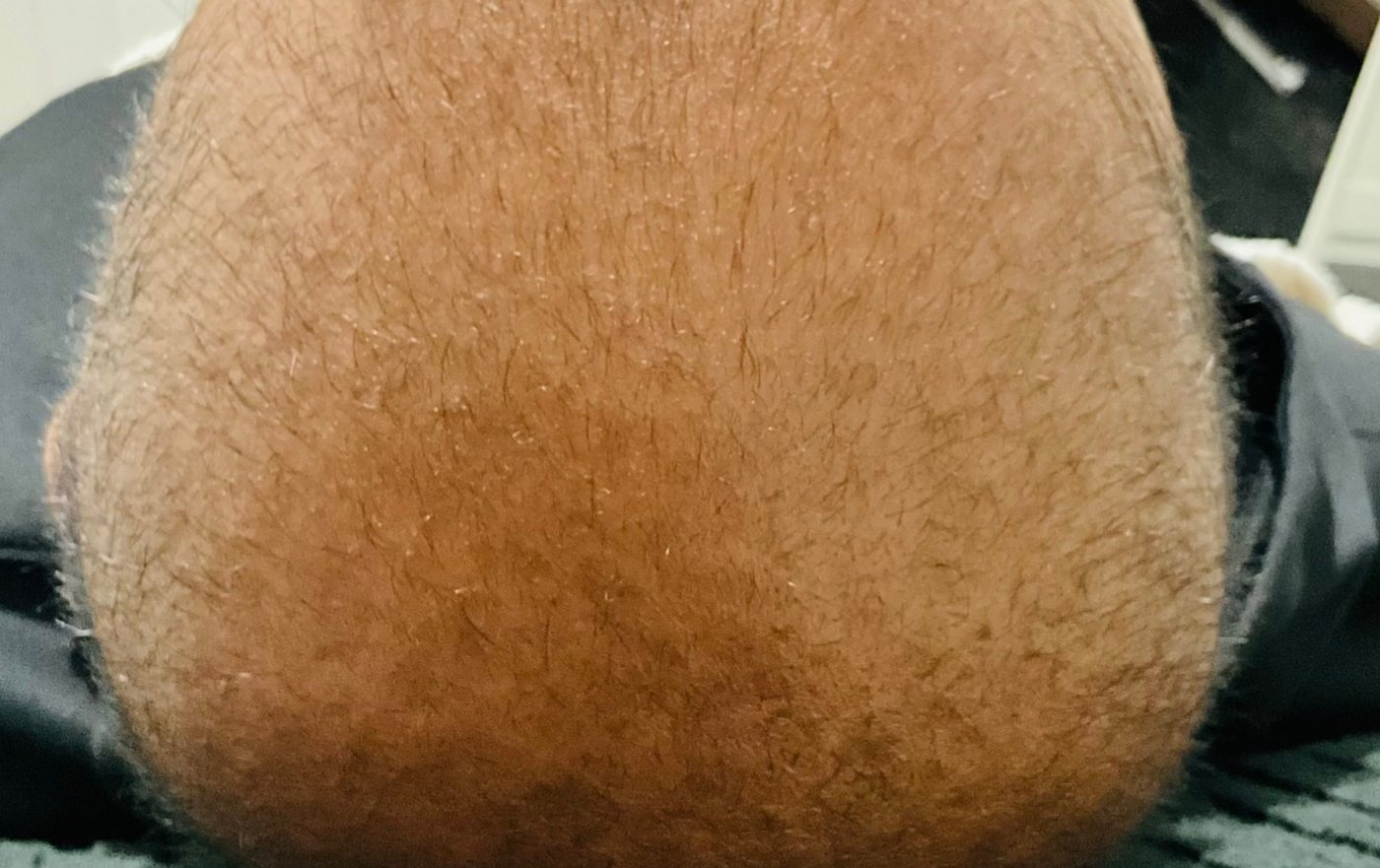 T-Lab™ PRP Kits and Tubes (Platelet-Rich Plasma Tubes)