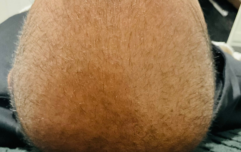 T-Lab™ PRP Kits and Tubes (Platelet-Rich Plasma Tubes)